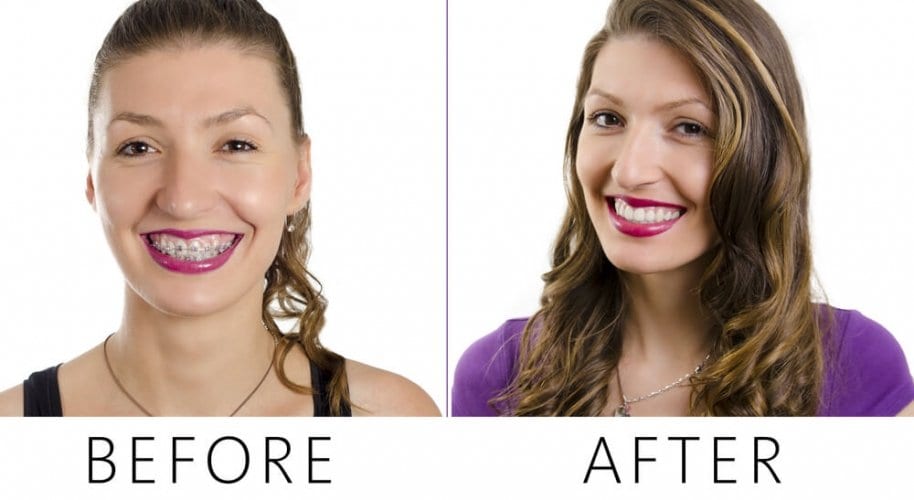 Braces Before and After: Changes Braces Can Make